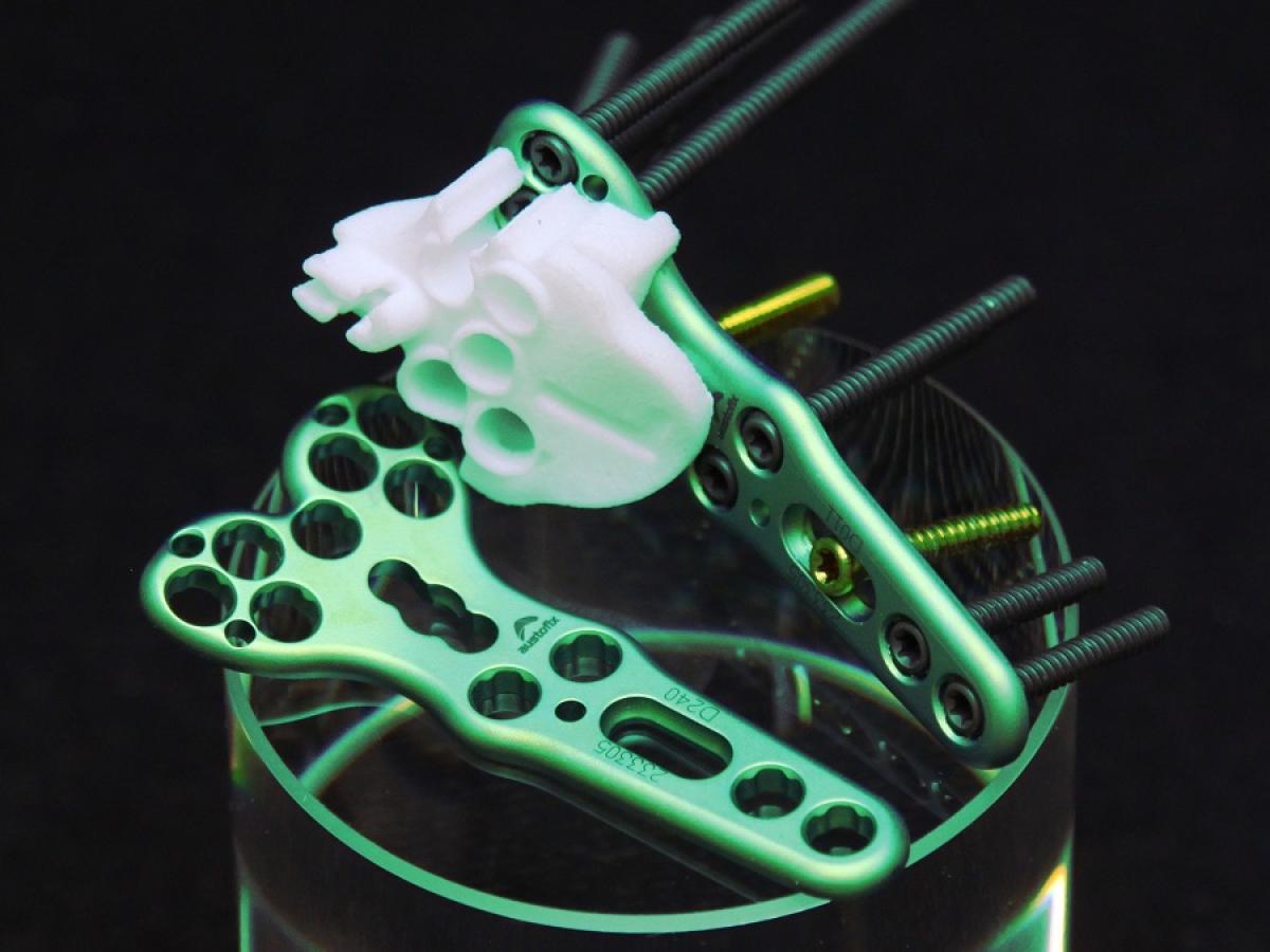 Wrist plate to help fractures heal faster | OptoFab Adelaide ...